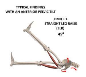 Anterior Pelvic Tilt... and its relationship to hamstring "tightness ...